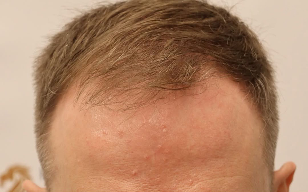 Hair Transplant Toronto | Hair Transplant Centre Toronto